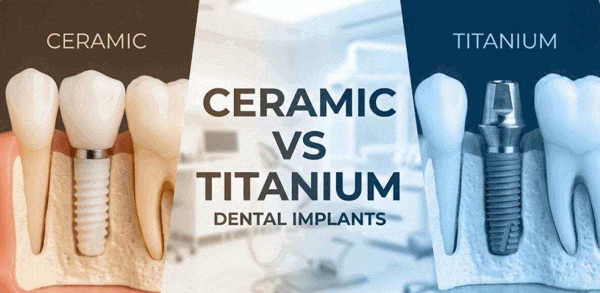 Ceramic vs Titanium Dental Implants: Comparison Guide